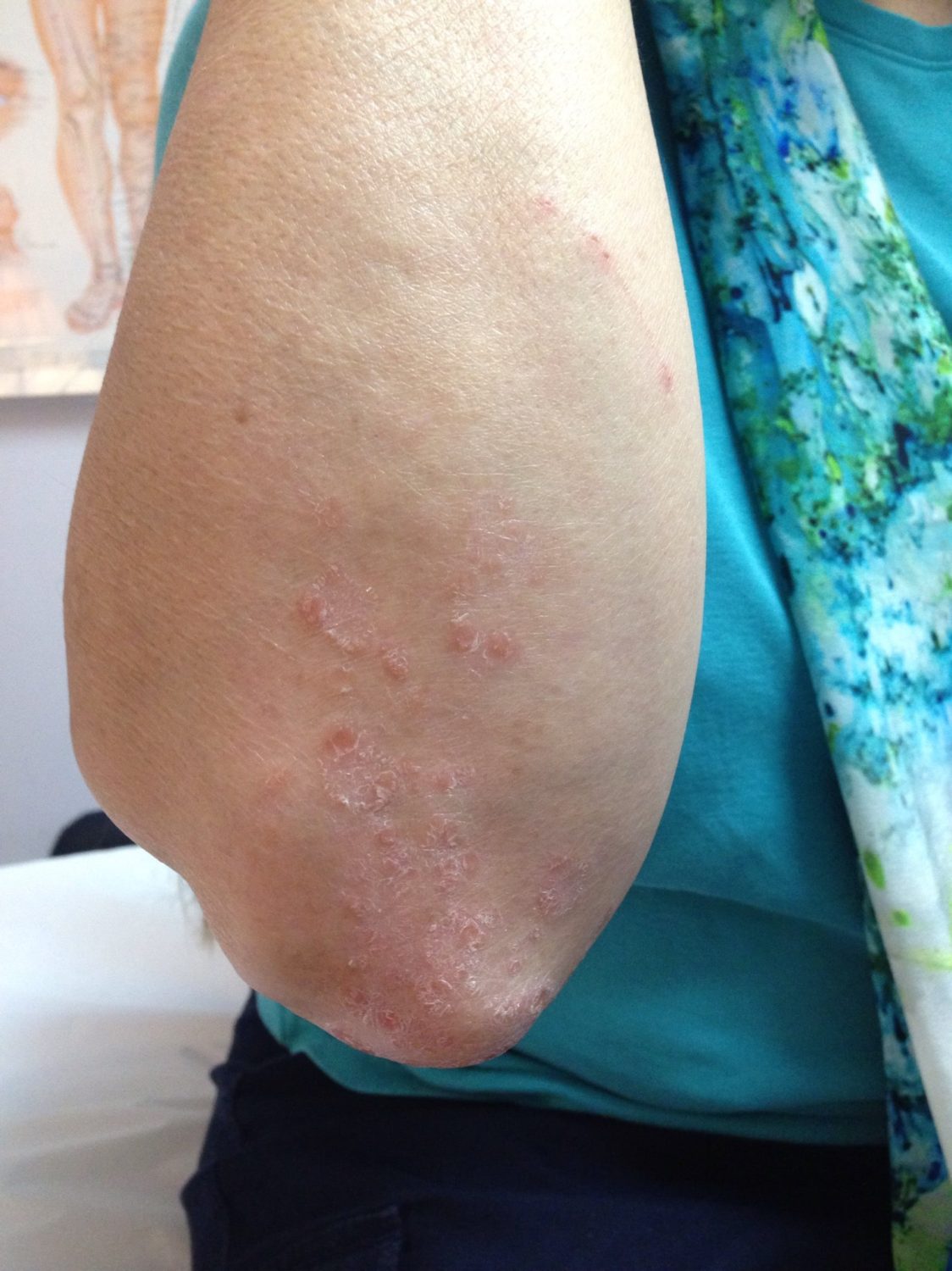 Acupuncture for Psoriasis: A Guide to Natural Remedies for your Skin